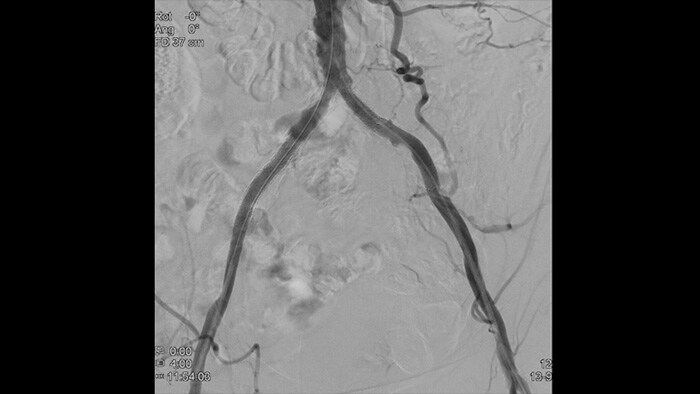 Aortic disease | Philips Healthcare