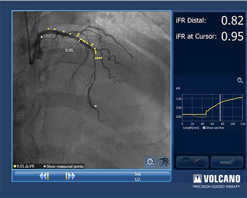 iFR and FFR help to guide PCI | Philips Healthcare